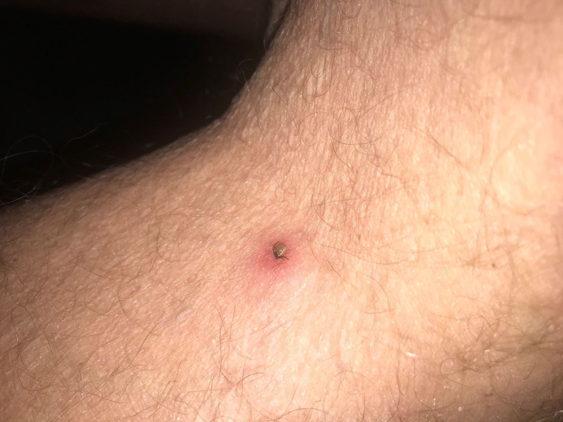 What Bit Me? How to Identify Common Bug Bites & Stings